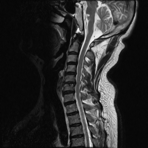 Chụp MRI cột sống cổ không tiêm thuốc đối quang từ