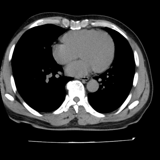 Chụp CT (chụp CLVT) lồng ngực có dựng hình xương 3D