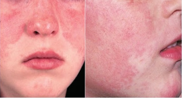 11+ nguyên nhân khiến bạn nổi ban đỏ trên da